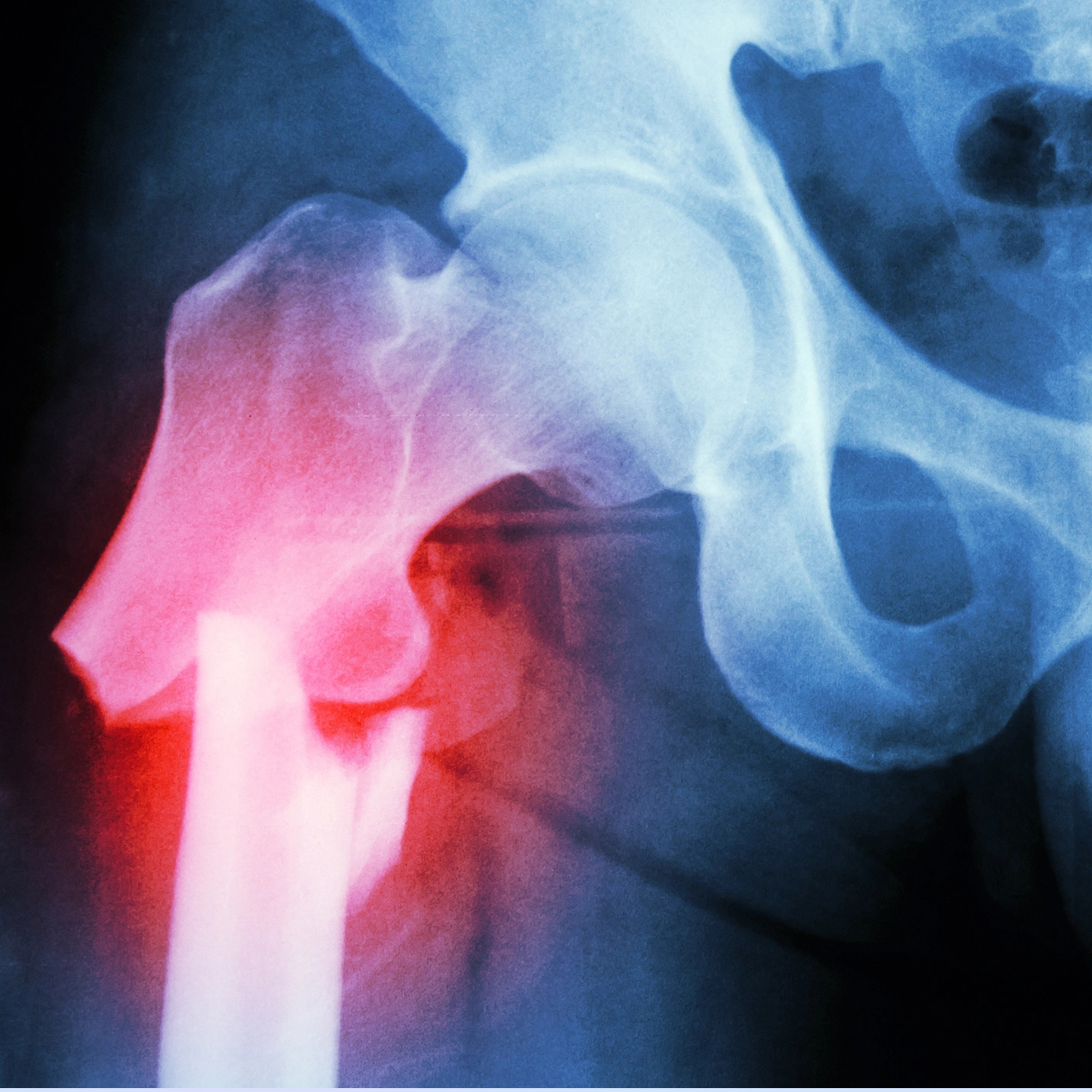 Orthopaedic Trauma - Adelaide OrthoCare