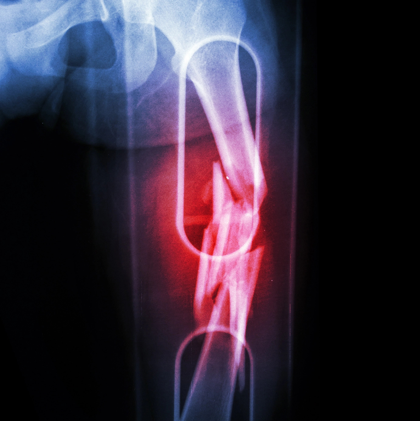 Orthopaedic Trauma - Adelaide OrthoCare